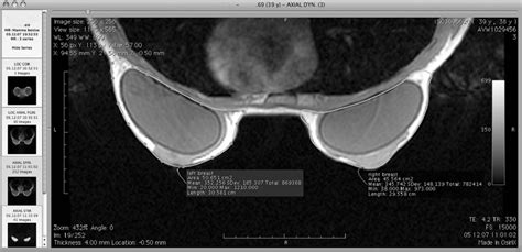 Mri Breast Volumetry Using Osirix© V 3 0 2 32 Bit The Breasts With