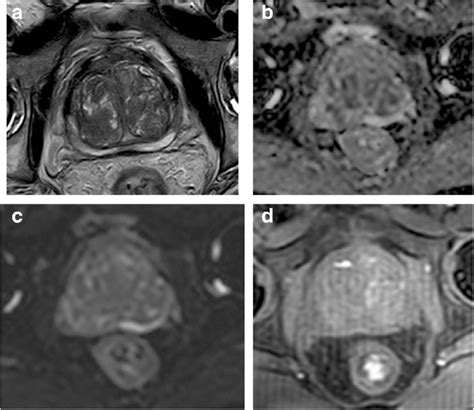 Pi Rads Iii Prostate Cancer A Axial T2 Wi Shows Tz Heterogeneous