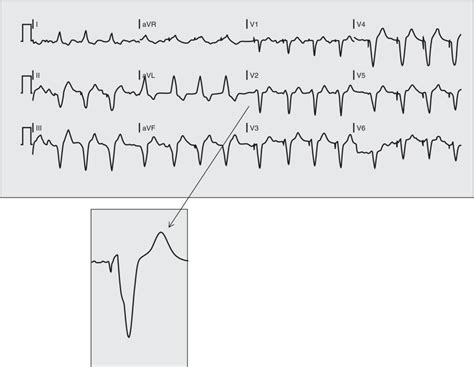 Electrocardiographic Differential Diagnosis Of St Segment Elevation