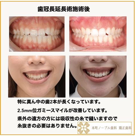 歯が歯ぐきに埋もれていて、 さらに笑うと過剰に唇が上がる ガミースマイルの方の治療方法 本町の矯正・歯科 本町ノーブル歯科 矯正歯科
