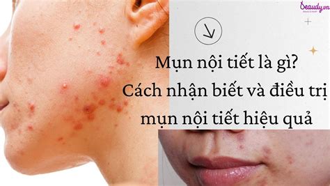 Mụn Nội Tiết Là Gì Cách Nhận Biết Và điều Trị Mụn Nội Tiết đúng Cách