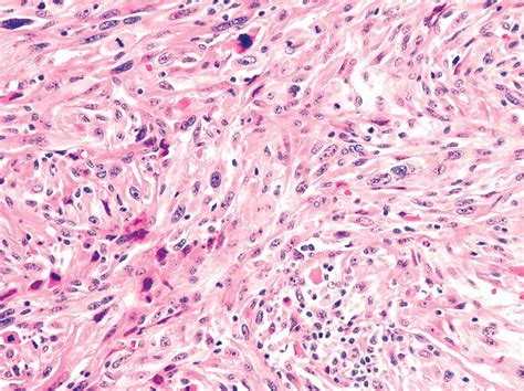 Pathology Outlines Undifferentiated Pleomorphic Sarcoma