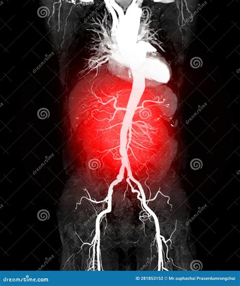 Cta Whole Aorta With Abdominal Aorta Stent Graft Compare 3d Rendering