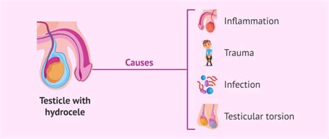 Causes Of Testicular Hydrocele