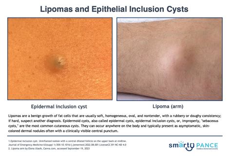 Sebaceous Cyst And Lipoma Difference