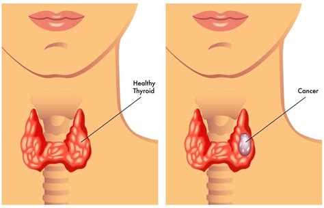 Thyroid Cancer Symptoms Causes Diagnosis Treatment And Prevention