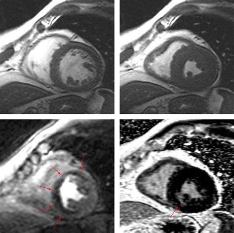 Advances In Clinical Applications Of Cardiovascular Magnetic Resonance
