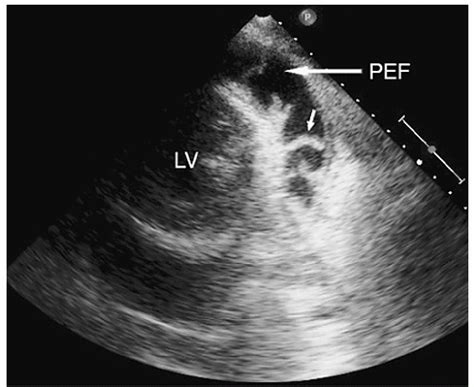 Pericardial Diseases Thoracic Key