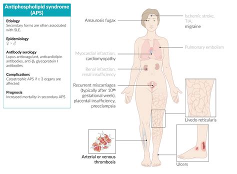 Antiphospholipid Syndrome Video Anatomy Definition 49 Off