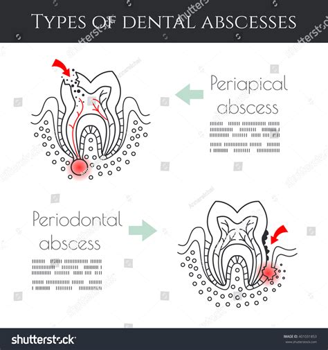 Types Dental Abscessesdental Infographic All Objects Stock Vector