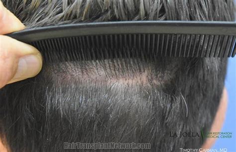 Dr Timothy Carman Hair Transplant Surgical Procedure Before And After