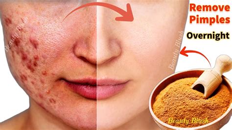 How To Remove Pimples Overnight Acne Treatment Remove Acne Pimples