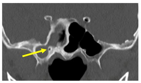 Sinusitis An Open Access Journal From Mdpi