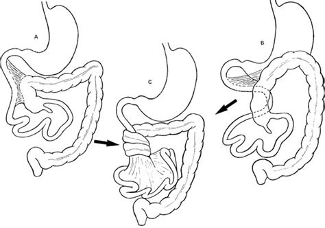 Intussusception And Midgut Volvulus 2015 05 12 Ahc… Relias Media