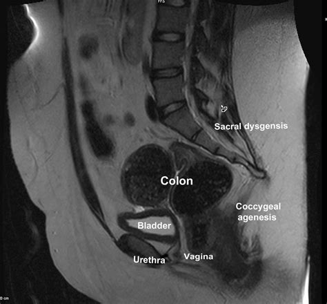 Mullerian Agenesis Ultrasound