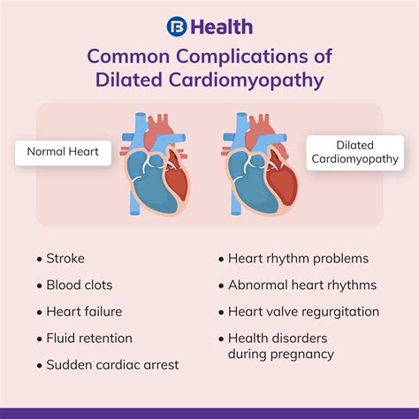 Dilated Cardiomyopathy Symptoms And Causes Artofit