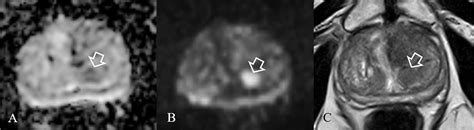 Index Lesion Detection In Multifocal Prostate Cancer Simplified Pi
