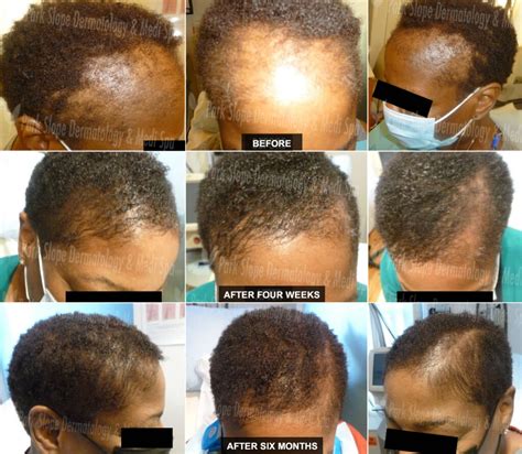 Hair Loss Park Slope Dermatology Brooklyn Nyc