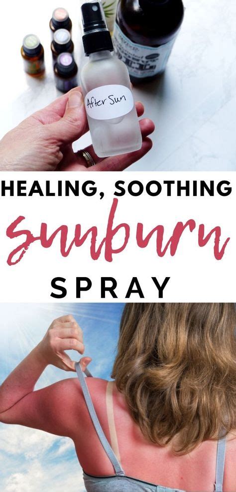 How To Heal Sunburn Fast With Essential Oils Heal Sunburn Fast