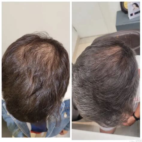 Hair Regrowth Treatment In Delhi Hair Regrowth Treatment Cost In Delhi