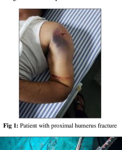 Figure 1 From Functional Outcome Of Operative Vs Conservative