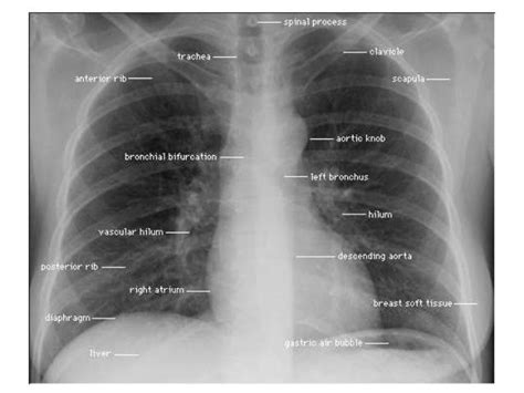 Chest X Rays X Ray Bronchial Pleural Effusion 8820 Hot Sex Picture