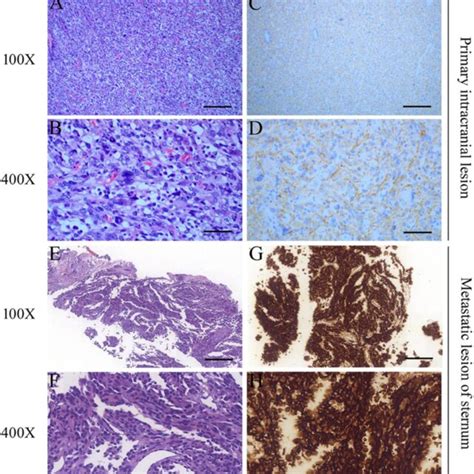 A Hematoxylin And Eosin He Staining Of Intracranial Lesions
