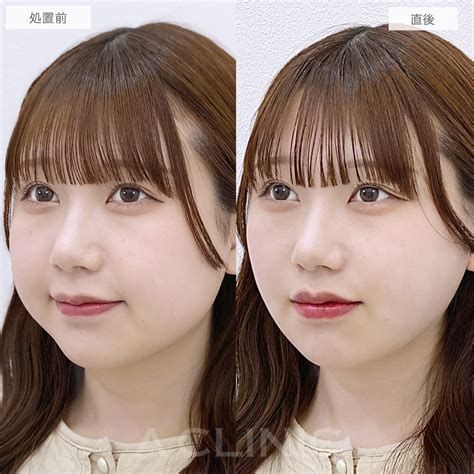 1day小顔脂肪吸引は直後とは思えない程自然と小顔になります！処置前と処置直後の症例です 20代女性 A Clinicは小顔・リフト