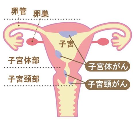子宮がんのことなら広島の漢方薬局ハーブス