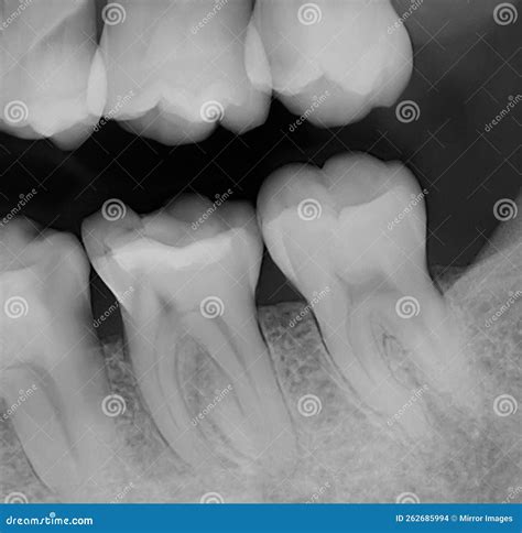 Adult Patient Xray Of Teeth Numbers 13 14 15 18 19 And 20 One Tooth