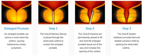 Benign Prostatic Hypertrophy Bph Prostate Enlargement South West