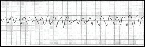 basic ekg rhythm strips telemetry technician course practice ekg class 8