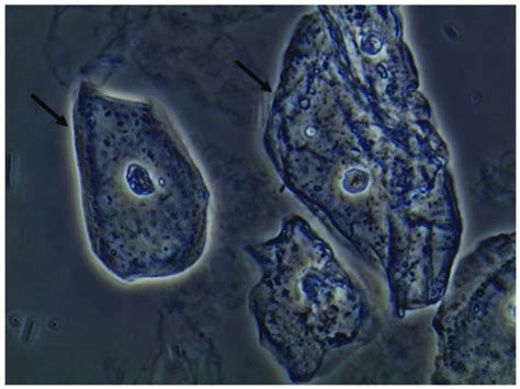 Urine Sediment Of The Month Flavors Of Nucleated Cells 52 Off