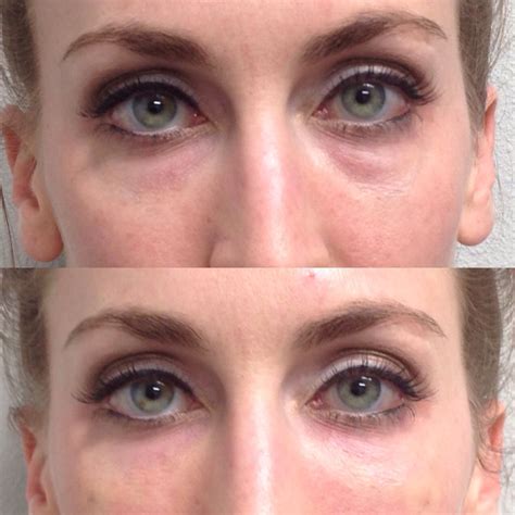 List 103 Pictures Tear Trough Before And After Photos Stunning 10 2023