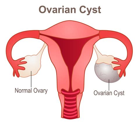 Ovarian Cysts Types Symptoms Diagnosis And Treatment Ask Dr Angela