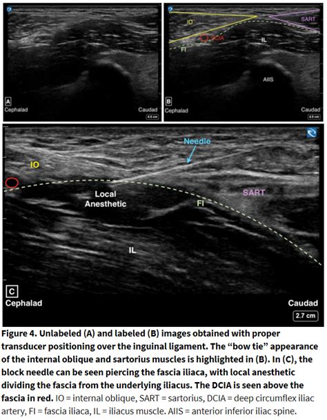 how i do it suprainguinal fascia iliaca block