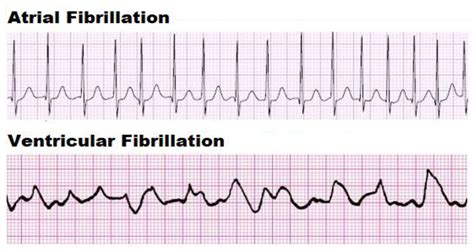 Ventricular Fibrillation Vs Atrial Fibrillation