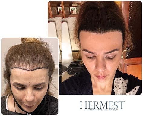 Why Turkey Is The Global Leader In Hair Transplantation Hermest Clinic