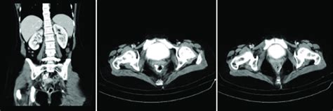 Computed Tomography Scan Of The Abdomen And Pelvis Showing