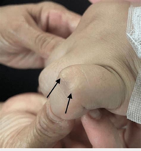 Subcutaneous Nodules Over The Interphalangeal Joints Download