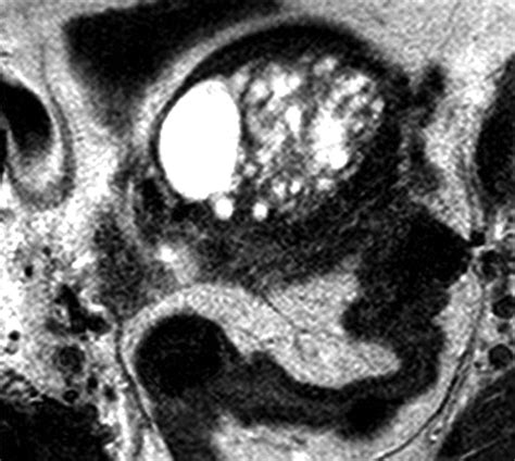 Multilocular Cystic Lesions In The Uterine Cervix Broad Spectrum Of