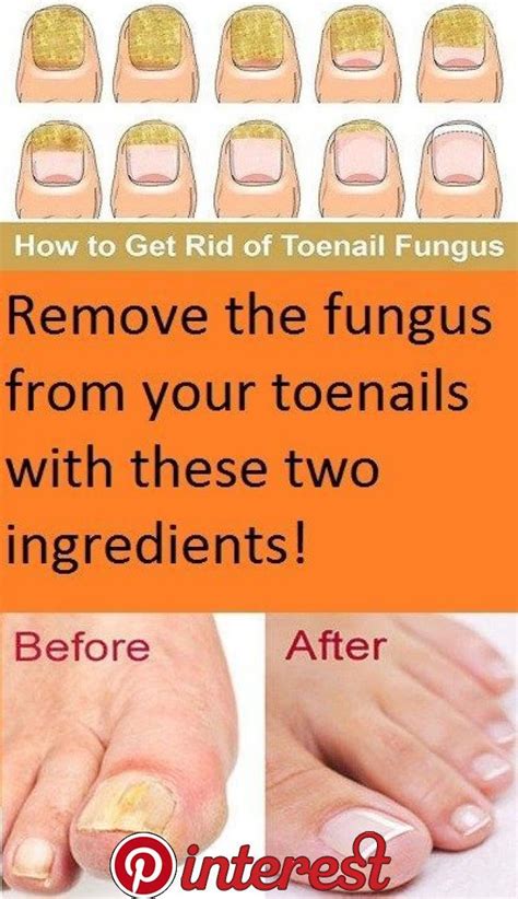 Remove The Fungus From Your Toenails With These Two Ingredients Remove