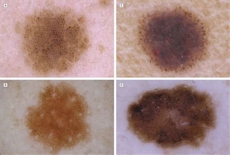 frequency of dermoscopic nevus subtypes by age and body site a cross