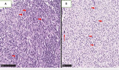 Histological Features Of Nodular Lymphocyte Predominant Hodgkins