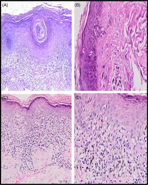 Histopathological Images From The Cases A Focal Hypergranulosis