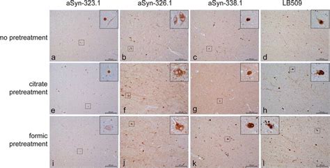Immunohistochemical Detection Of Pathological α Synuclein In Pd Brain