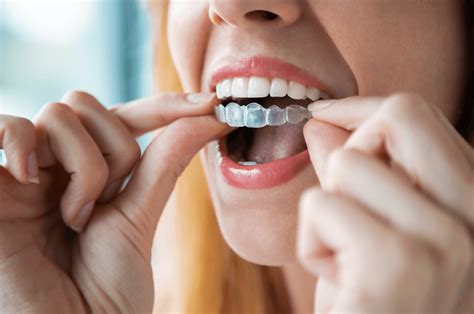 How Do Clear Aligners Work Arnold Dental Arnold Nottingham