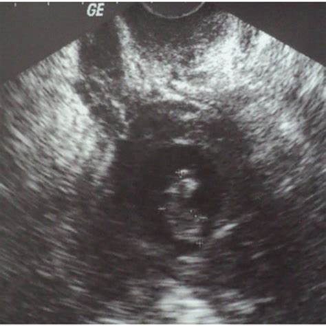 Transvaginal Ultrasound Imaging Showing An Intrauterine Proliferation