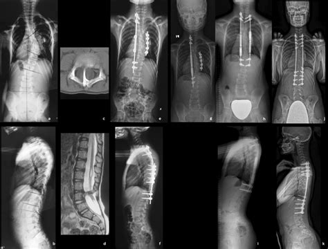 Preoperative A Ap And B Lateral Radiographs And C Axial Ct And D