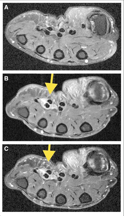A Baseline Fat Suppressed T2 Weighted Image Of The Hand B C